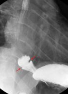 Esophageal webs and rings - Knowledge @ AMBOSS