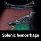 Splenic injuries - Knowledge @ AMBOSS